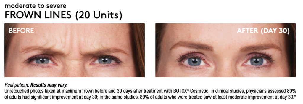 Botox Before and After 4 - Success by Design